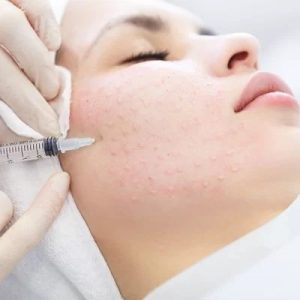 Mesotherapy - Alpha Medical
